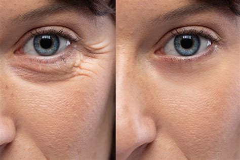 Twins Get Botox But Only One Has Smooth Skin What Was Different