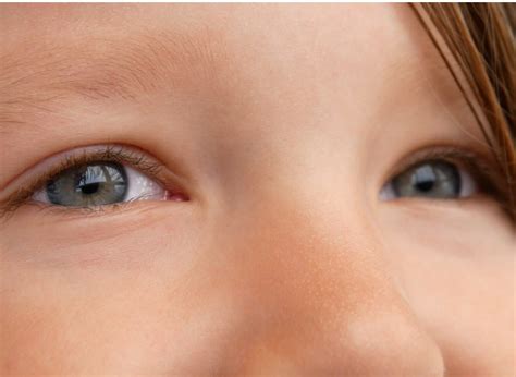 Linear Nevus Sebaceous Syndrome Lnss Symptoms And Care