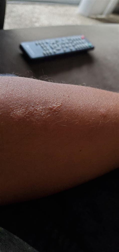 what are these patches stress related r dermatologyquestions