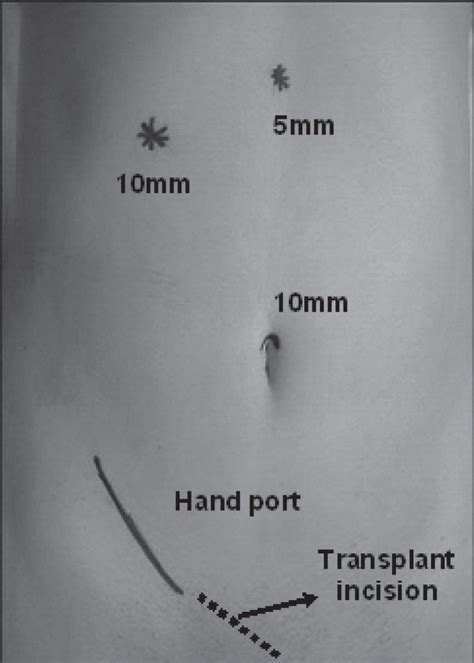 Hand Assisted Laparoscopic Right Nephrectomy And Autotransplantation