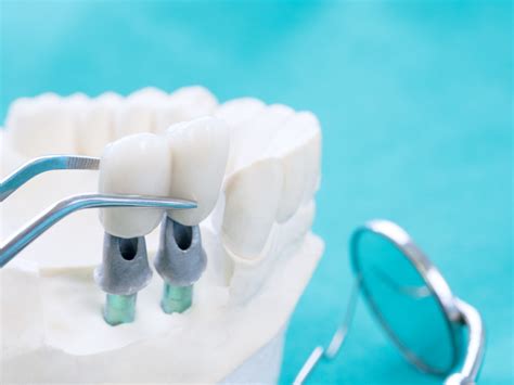 Expert Dental Implants Services In Houston Texas Omega Dental