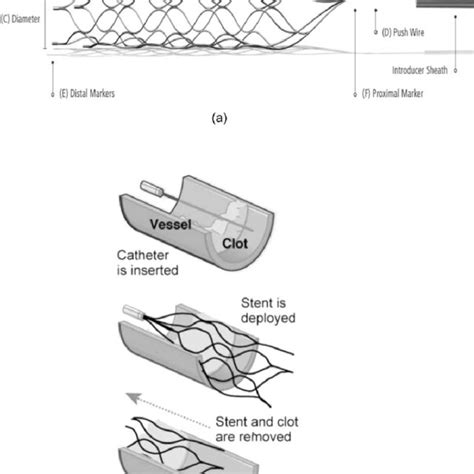 Solitaire Stent Retrieval Device A Detailed Image Of The Solitaire Download Scientific