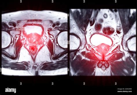 Mri Of The Prostate Gland Reveals Focal Abnormal Si Lesion At Left Pzpl