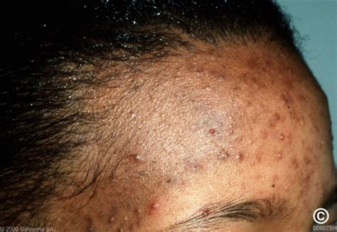 Mild Acne On Forehead
