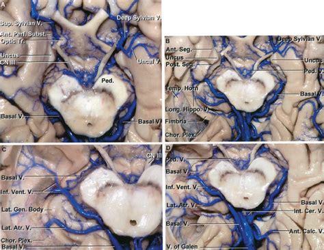 Inferior View Of The Basal Cisterns Neuroanatomy The Neurosurgical