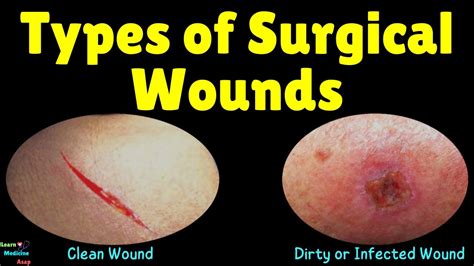 Surgical Site Wound Classification