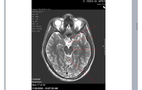 Brain Ct Scan Slice 9 Diagram Quizlet