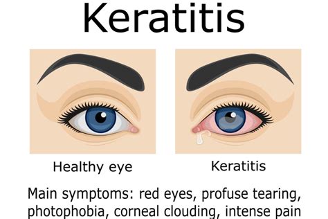 Penyakit Keratitis Gejala Penyebab Pengobatan