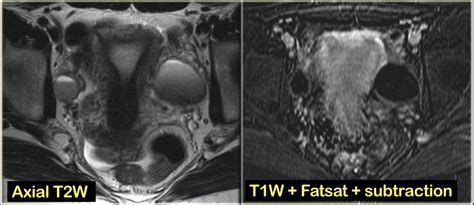 The Radiology Assistant Ovarian Cystic Lesions