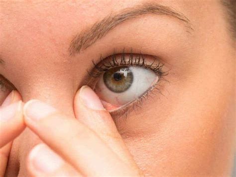 Corneal Ulcer Symptoms
