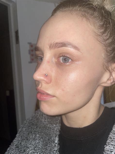 How Do I Get Rid Of This Hypertrophic Scarring I Got My Piercing In