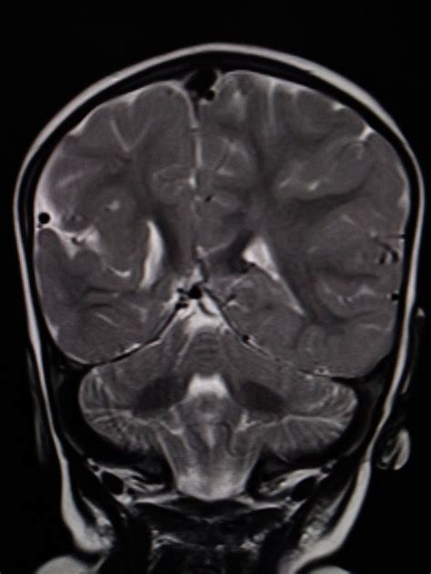 Right Perisylvian Syndrome With Polymicrogyria Radiologie Anatomie