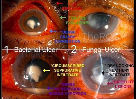 Bacterial Keratitis Vs Fungal Keratitis Photo Credit