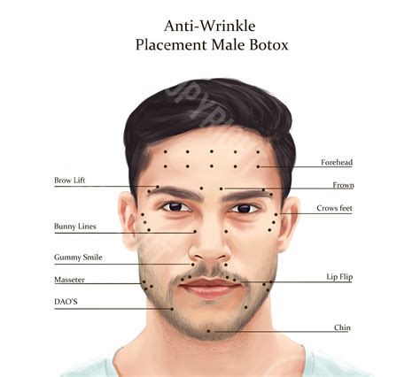 Male Botox Injection Points Bundle Botox And Filler Injector Anatomy Aesthetics