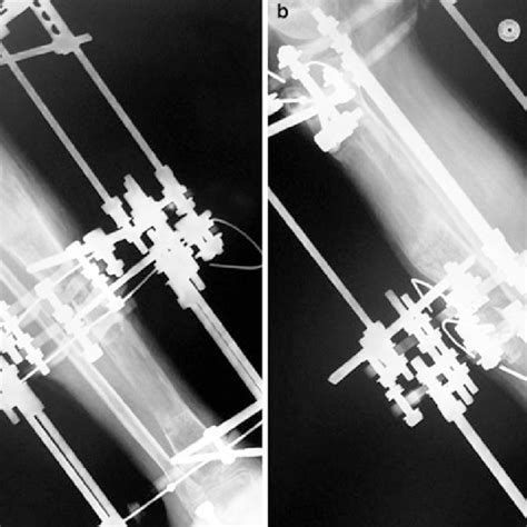 Pdf Reconstruction Of A Bone Defect Malignant Bone Tumor In The Diaphyseal Tibia Using