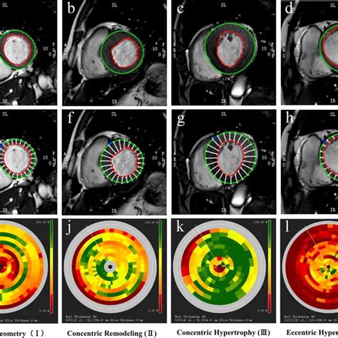 Image Processing Automation Improves Regional Myocardial Remodeling