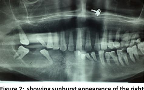 Figure 4 From Osteosarcoma Of The Mandible Developed After Tooth