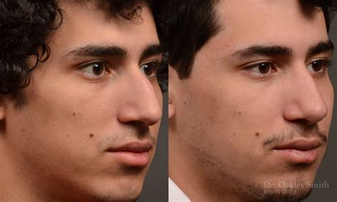 Rhinoplasty Before After Case 474 Toronto Rhinoplasty Surgery Nose
