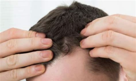 Acabar Calvo Como Mi Padre Son Iguales La Alopecia Masculina Y La