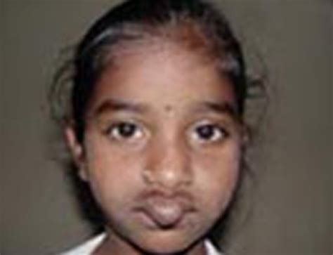 Vascular Malformation Hyderabad Cleft Society