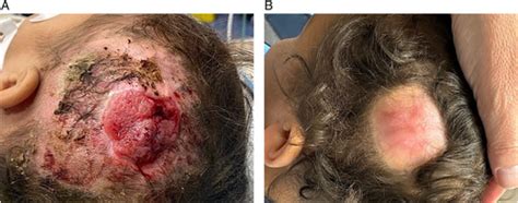 Management Of Hypergranulation Tissue A Report Of A Pediatric Case