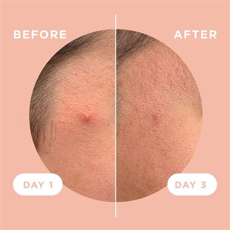 How To Get Rid Of Pimples Under The Skin