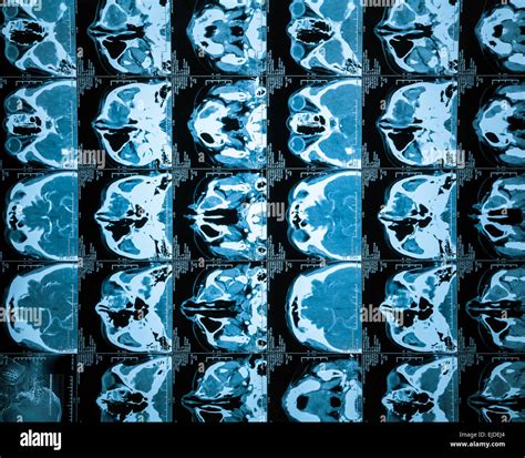 Anatomia Tc Encefalo Immagini E Fotografie Stock Ad Alta Risoluzione