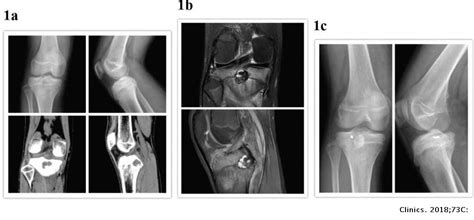 The Diagnosis And Treatment Of Tibial Intercondylar Chondroblastoma