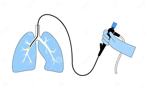 Bronchoscopy Procedure Concept Stock Vector Illustration Of