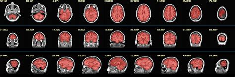 Severe Skull Stripping Errors Post Sswarper Afni Message Board Afni Discuss Message Board