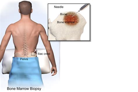 Home Bone Marrow Biopsy