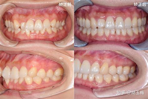 隐形矫正推磨牙向后矫正可以不拔牙 知乎
