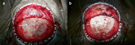 A Surgical Procedure Of Sinus Pericranii Resection Arrows Indicate The