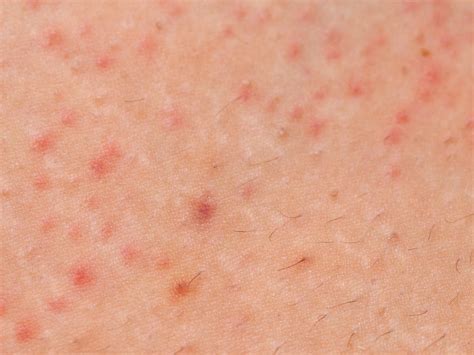 Mild Ringworm On Chest