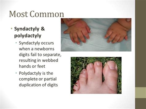 Congenital Anomalies And Their Incidence Rates Wadie Waterman Ppt Download