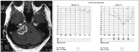Management Of Patients With Vestibular Schwannomas Acnr