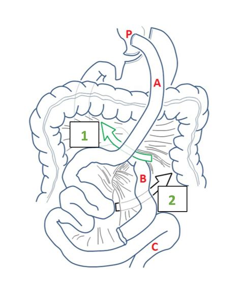 Acute Abdominal Pain After Roux En Y Gastric Bypass Swiss Knife