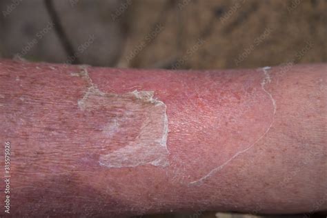 Cellulitis On Leg And Foot Of Mature Diabetic Man In Daylight Outdoors