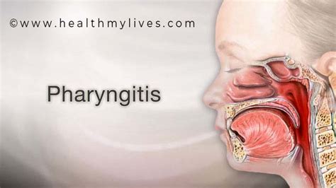 Pharyngitis Causes Symptoms And Prevention