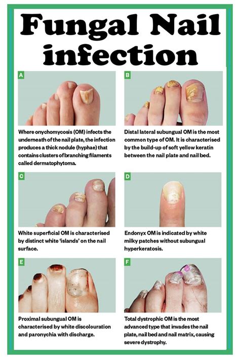 Toenail Fungus Symptoms Causes And Support Strategies Artofit