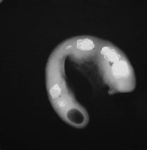 Appendix Fecalith 1368 Appendicitis Fecalith Surgery Photos