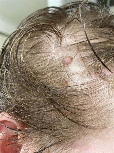 Circular Spots On Scalp Rdermatologyquestions