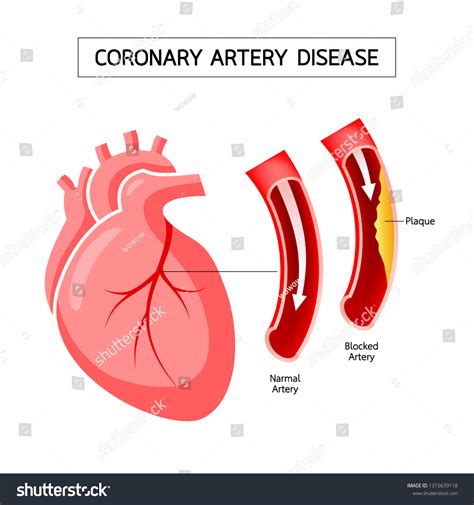 Human Heart Coronary Artery Disease Infographic Stock Vector Royalty