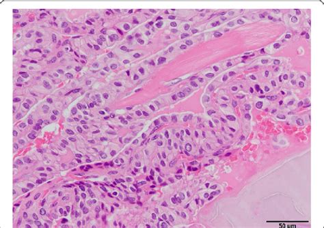 Pathological Findings Of The Thyroid Tumor Papillary Carcinoma With Download Scientific