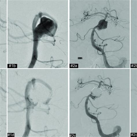 Postoperative And Preoperative Images Of The First Coil Embolization Download Scientific