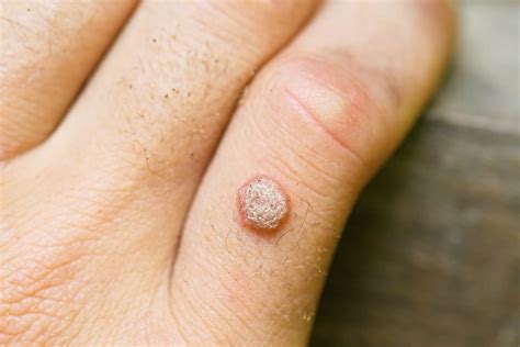 Viral Warts Symptoms