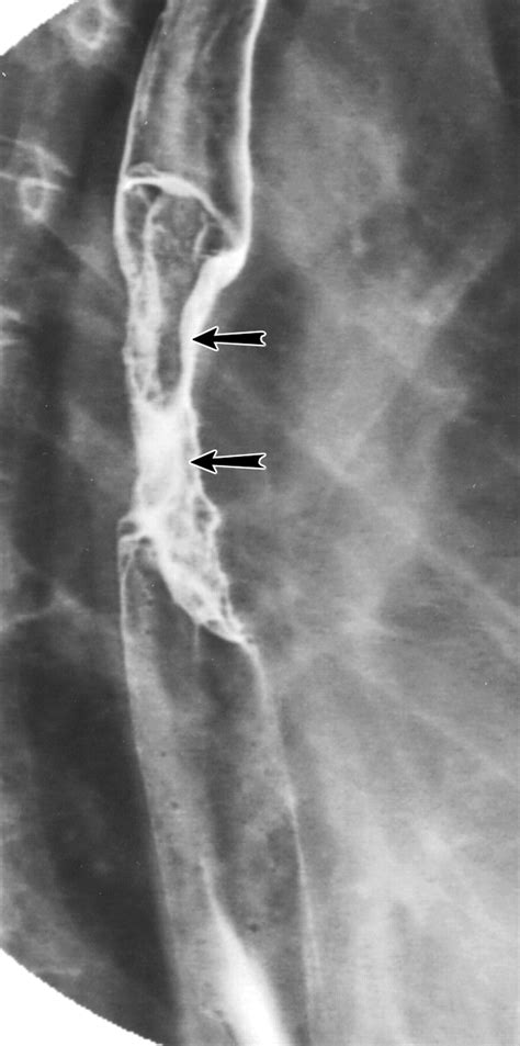 Diagnosis Staging And Follow Up Of Esophageal Cancer AJR