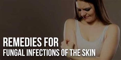 Natural Remedies For Fungal Infections Of The Skin Exeideas Lets