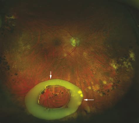 Dislocated Lens Ento Key