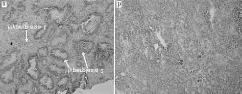 Histological View Of A Hyperplasia B Cancerous Prostate Tissue